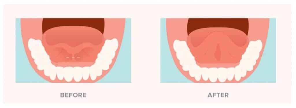 Tongue and Lip Tie-Frenectomy | Craniosacral Therapy NY