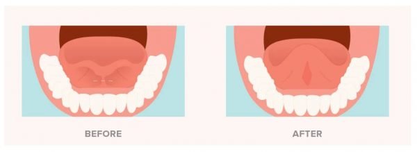 Tongue and Lip Tie-Frenectomy - Craniosacral Therapy NY